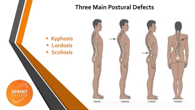 Postural Issues and Body Types | PPT