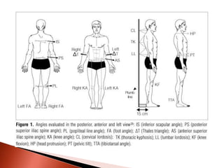 Over Flexed Posture Standing