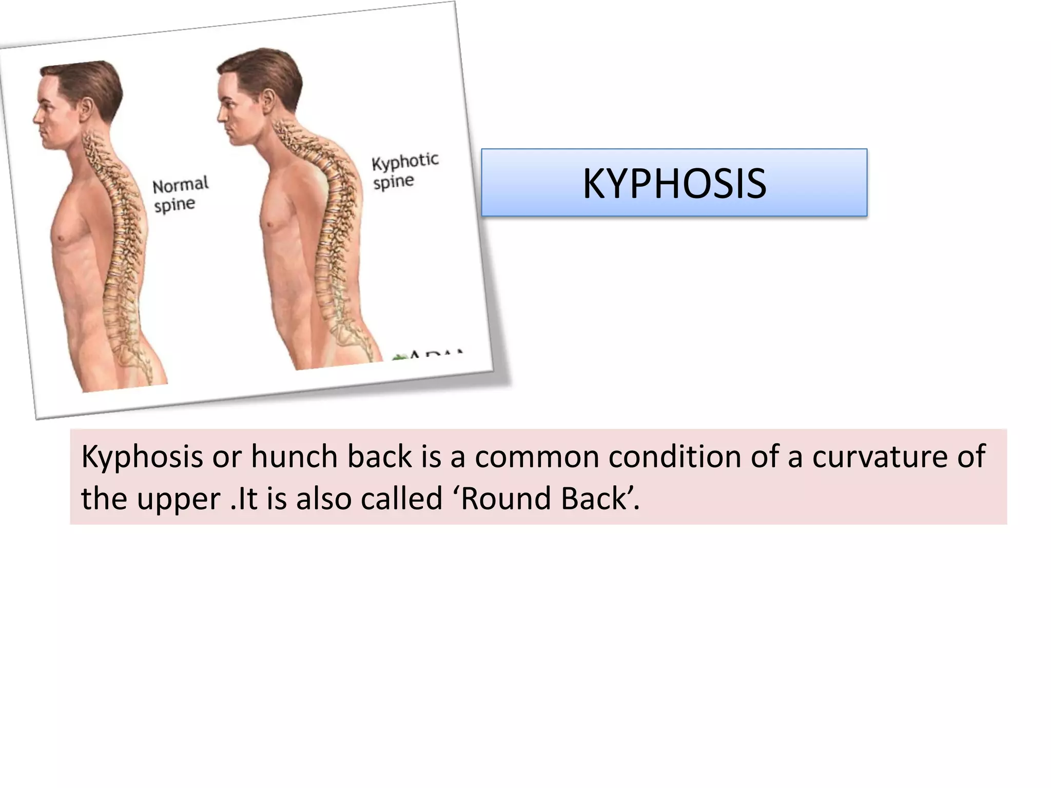 Good Posture and Bad posture | PDF
