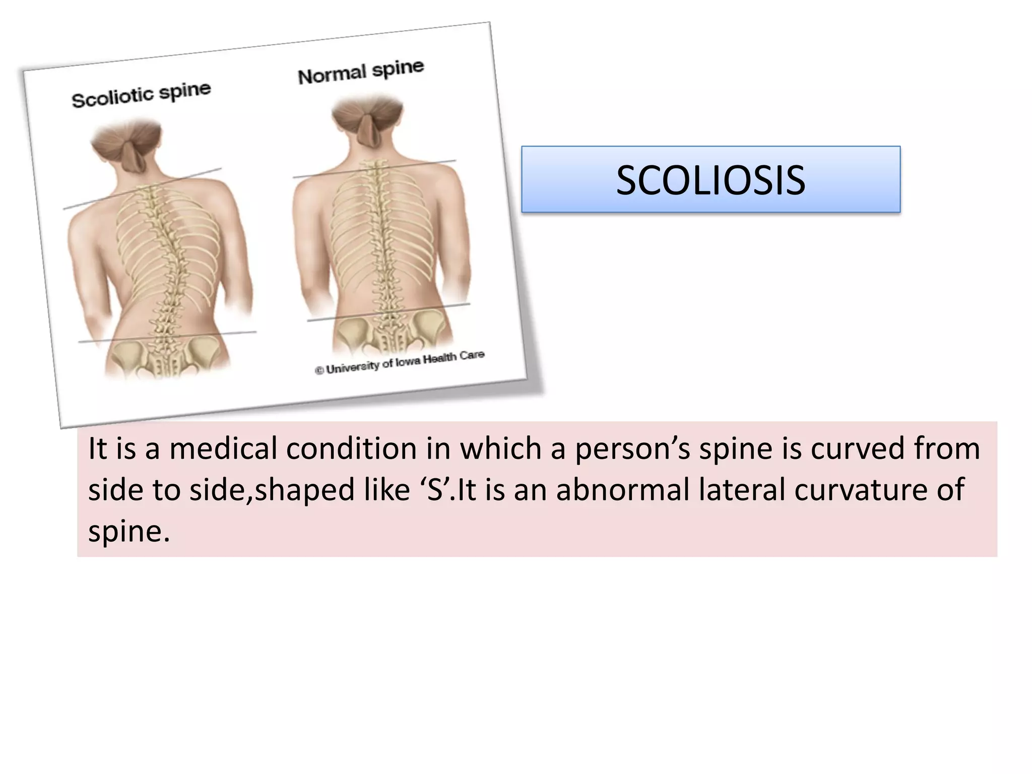 Good Posture and Bad posture | PDF