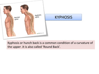 Good Posture and Bad posture | PDF
