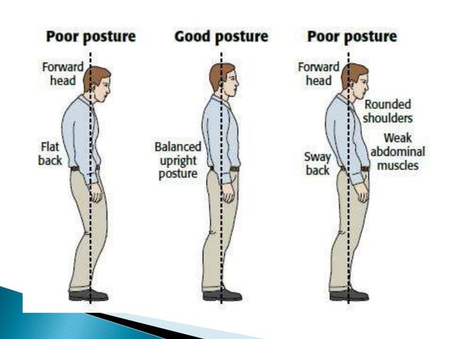 posture, cause, effect and remedial measures of bad posture | PPTX