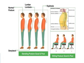 posture, cause, effect and remedial measures of bad posture | PPTX
