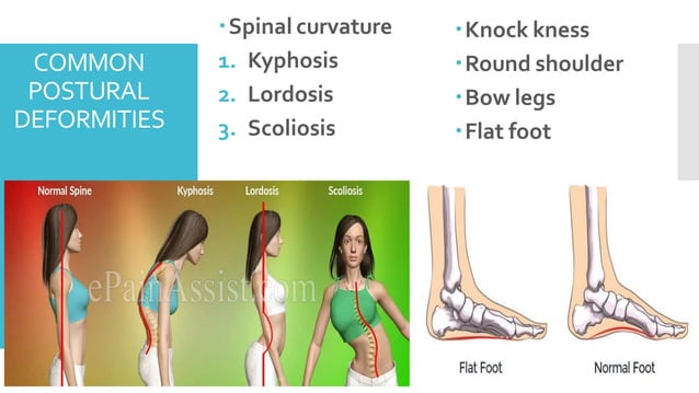 POSTURE AND ATHLETE care.pdf