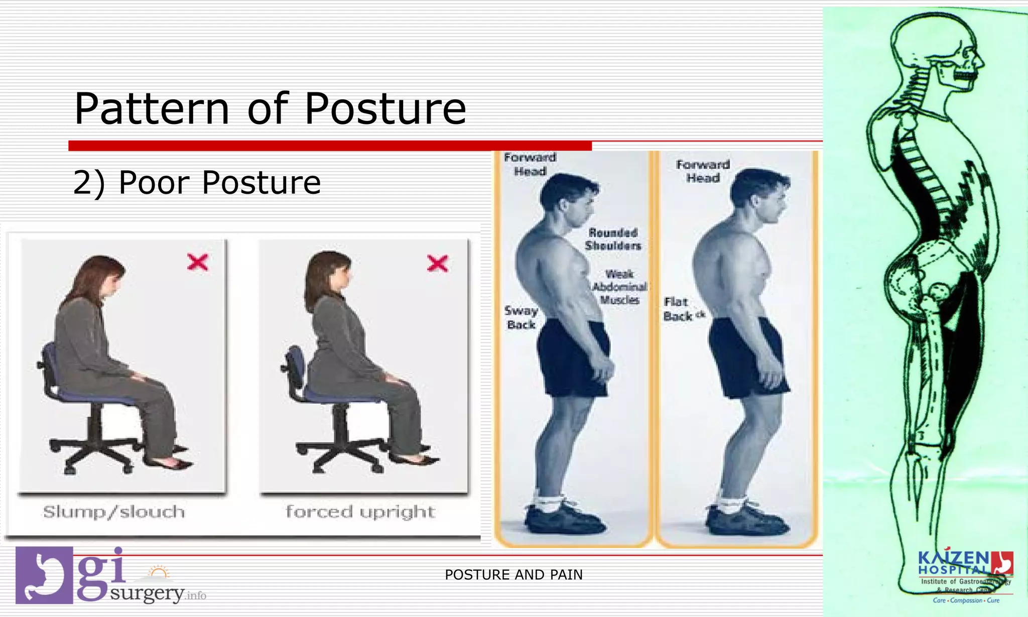 POSTURE AND PAIN - Gisurgery.info