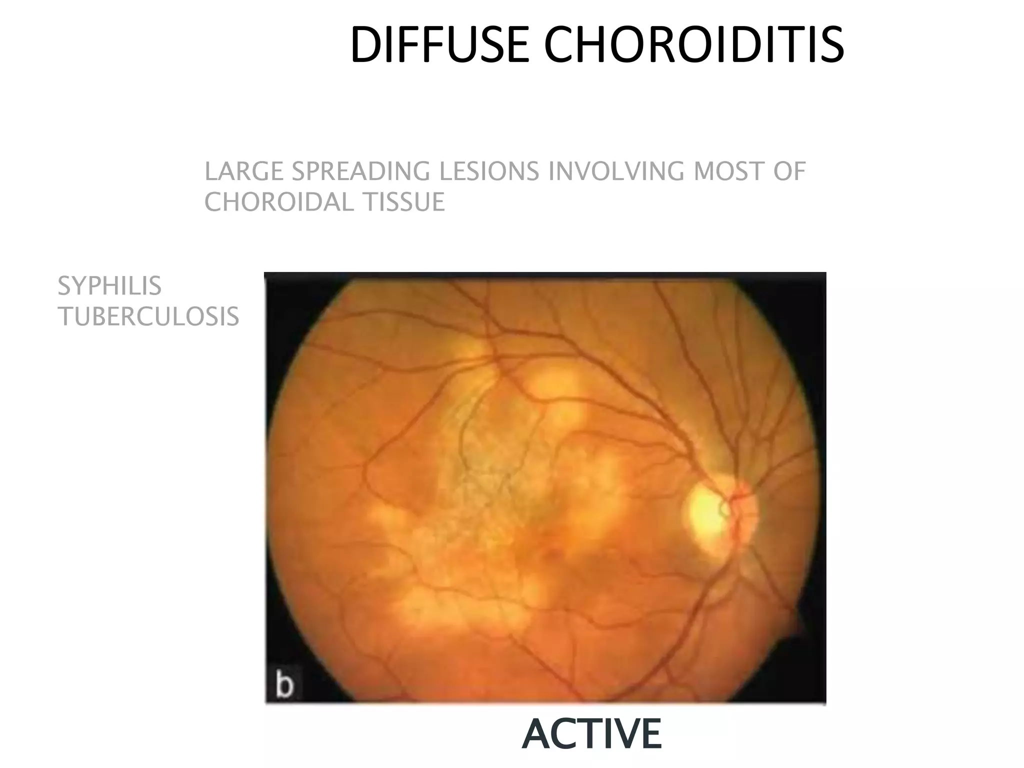 POST UVEITIS SEMINAR.pptx