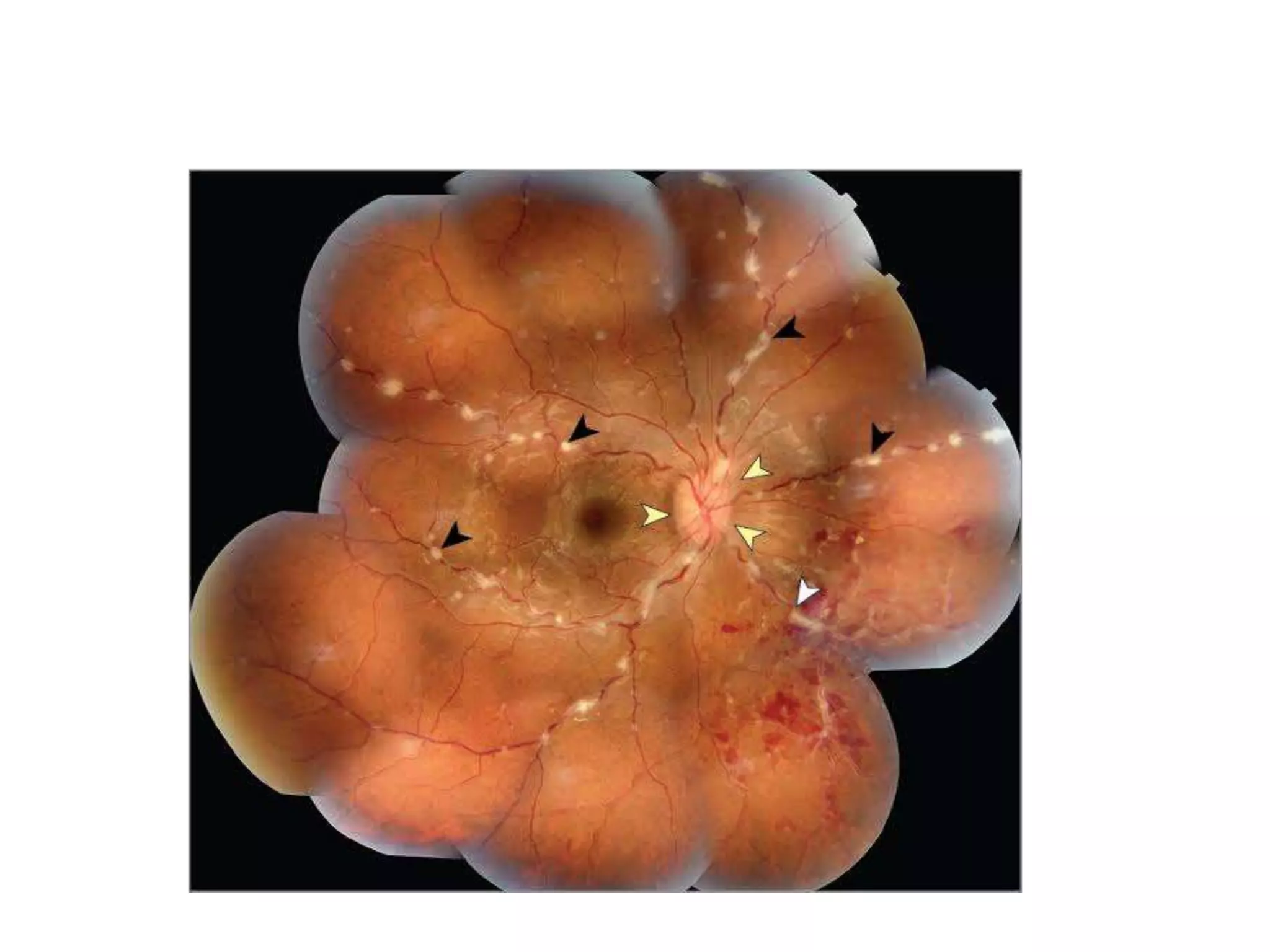 POST UVEITIS SEMINAR.pptx