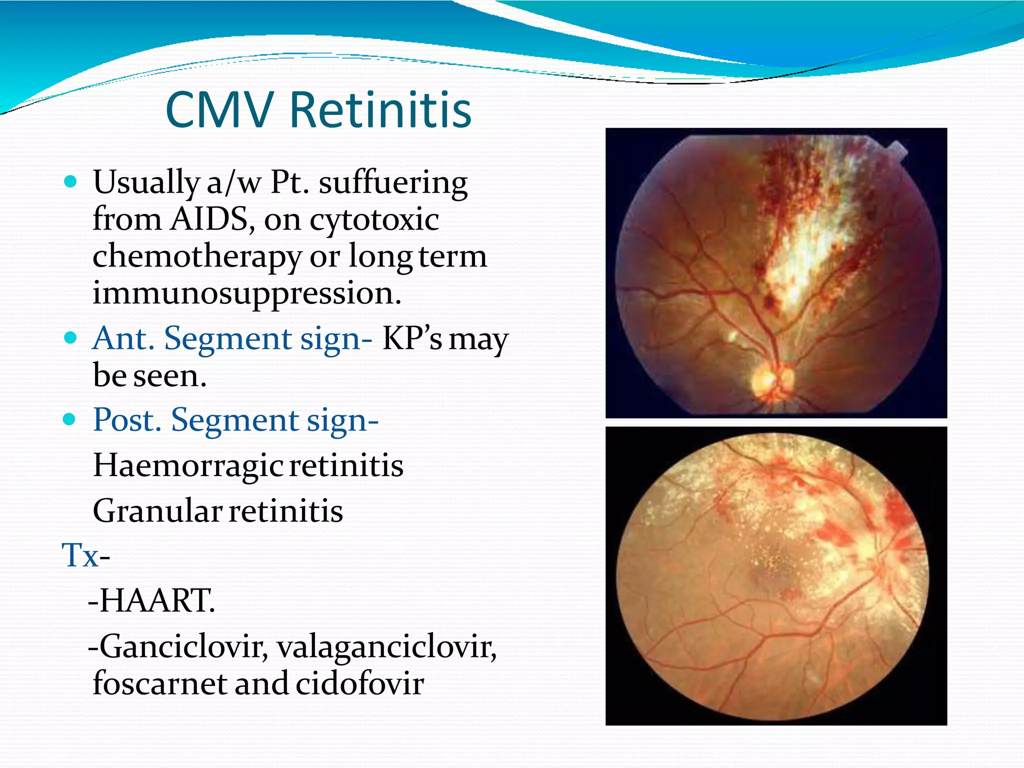 POST UVEITIS SEMINAR.pptx
