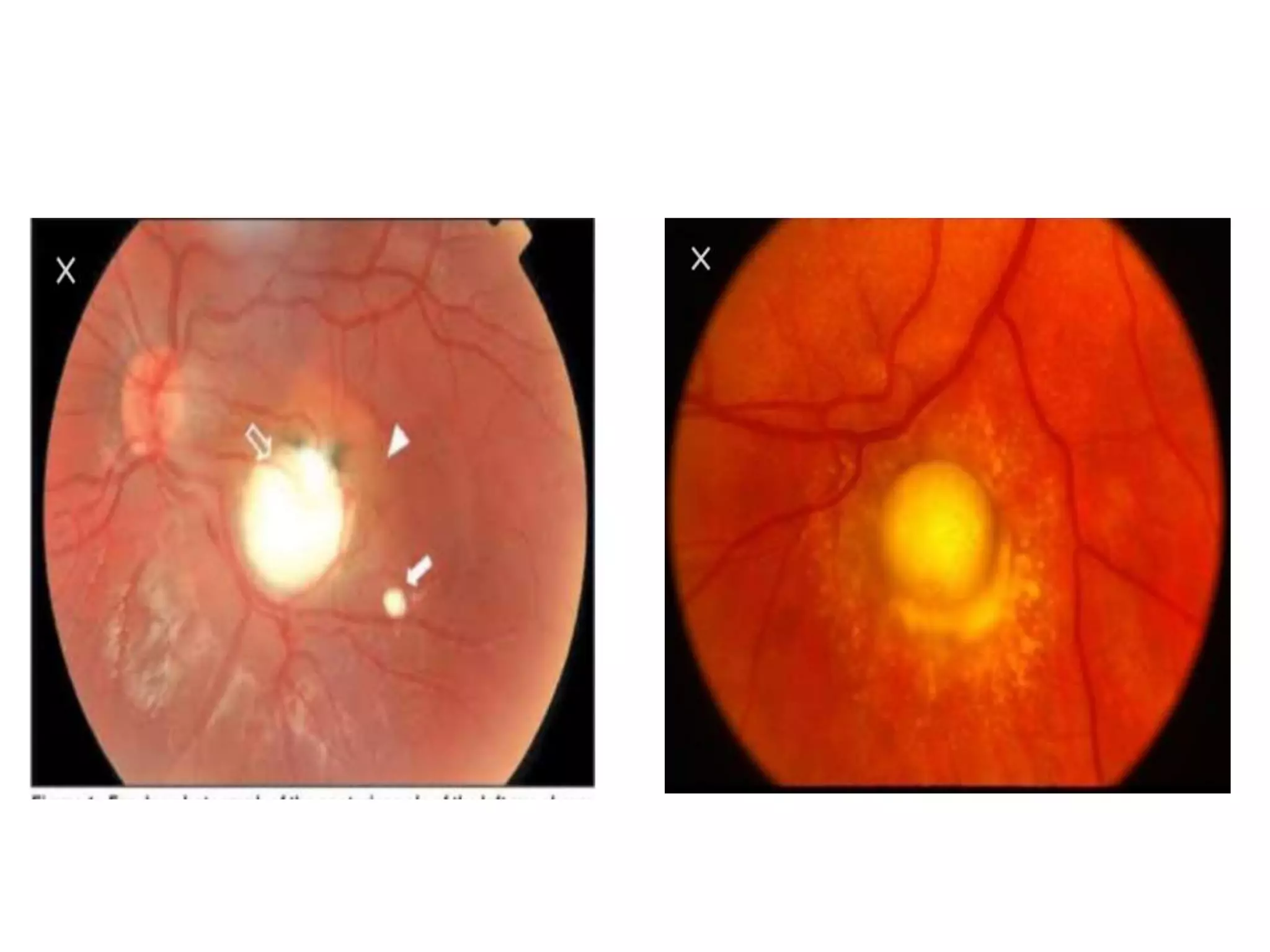 POST UVEITIS SEMINAR.pptx