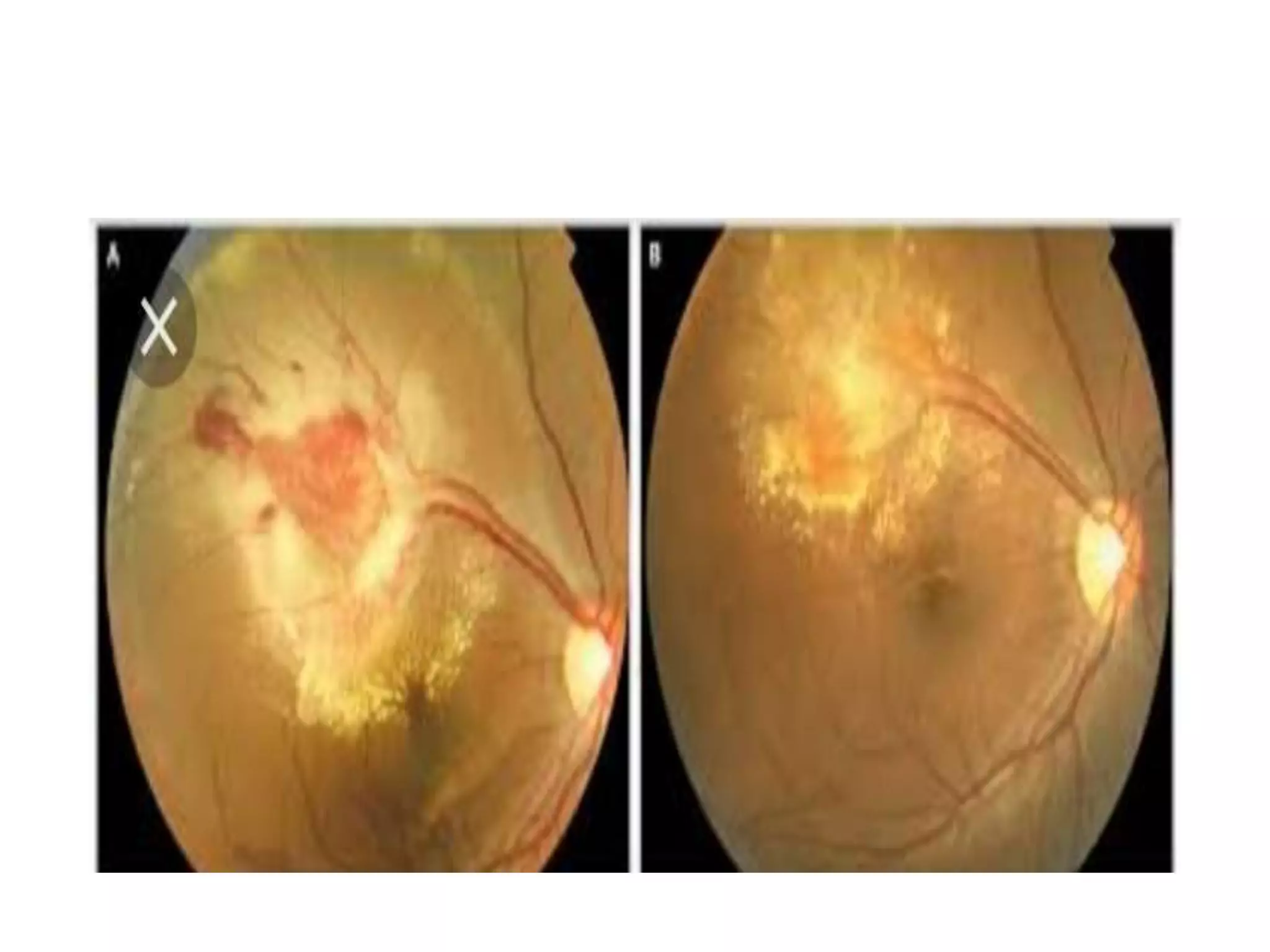Post Uveitis Seminar Pptx