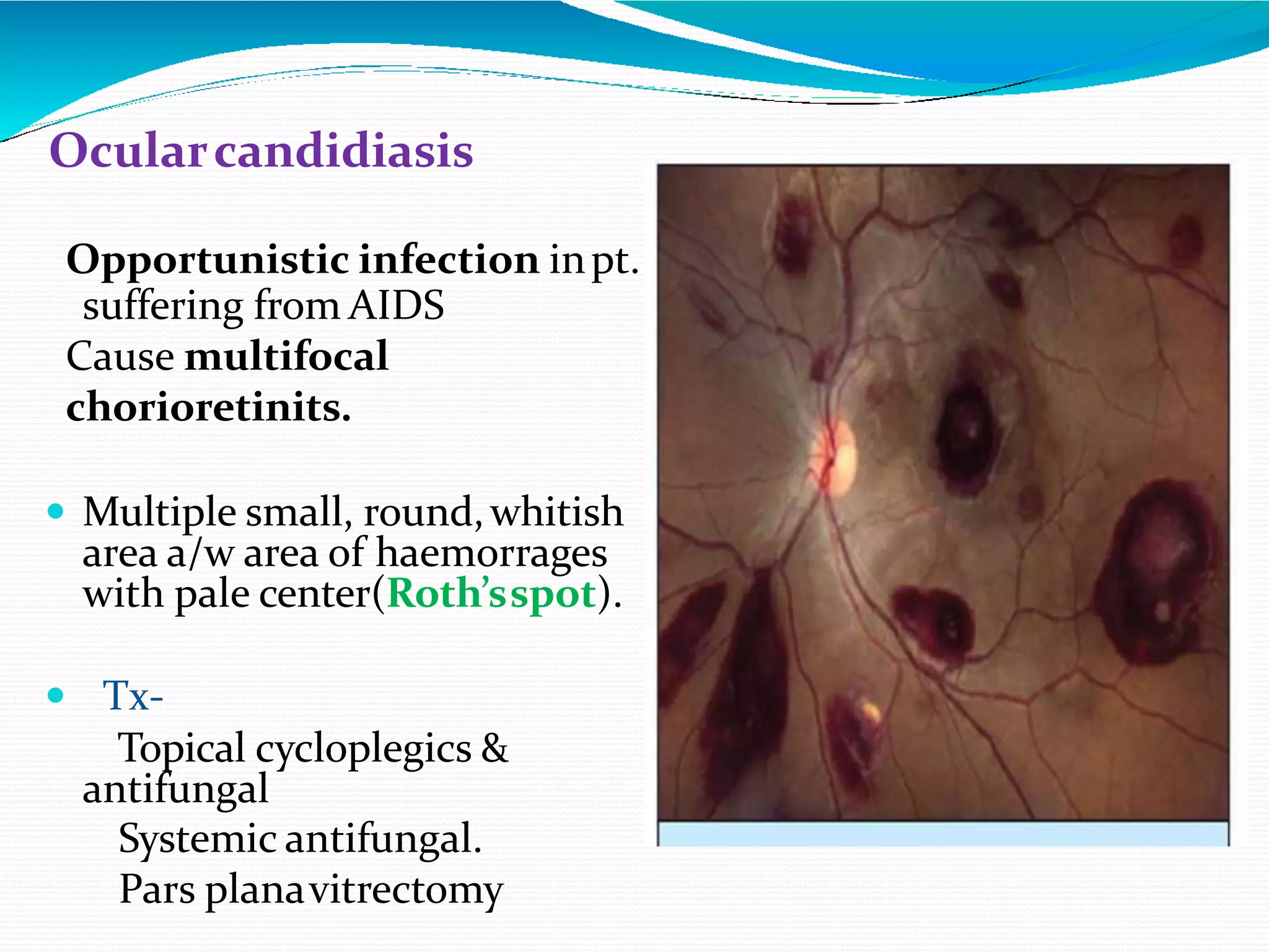 POST UVEITIS SEMINAR.pptx