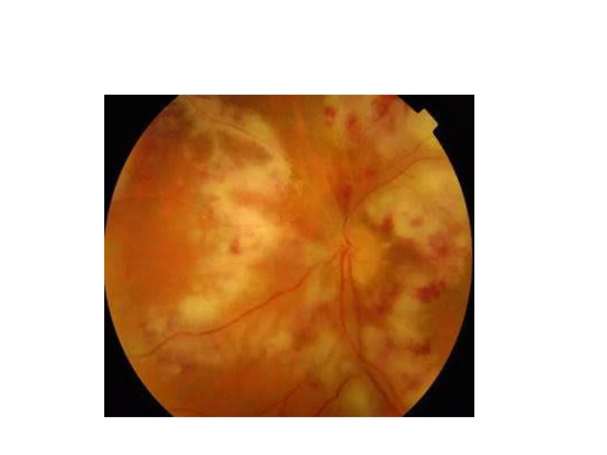 POST UVEITIS SEMINAR.pptx