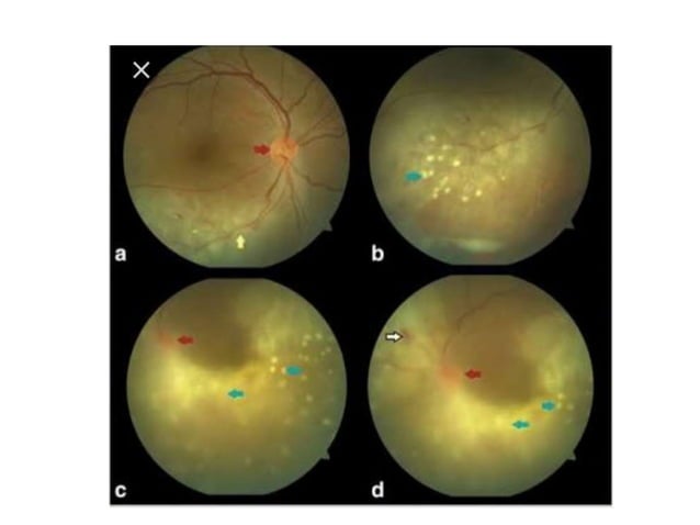 Post Uveitis Seminar Pptx
