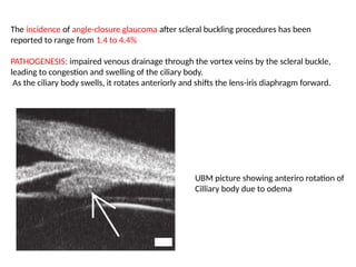 POST VITREORETINAL SURGERY GLAUCOMA.pptx