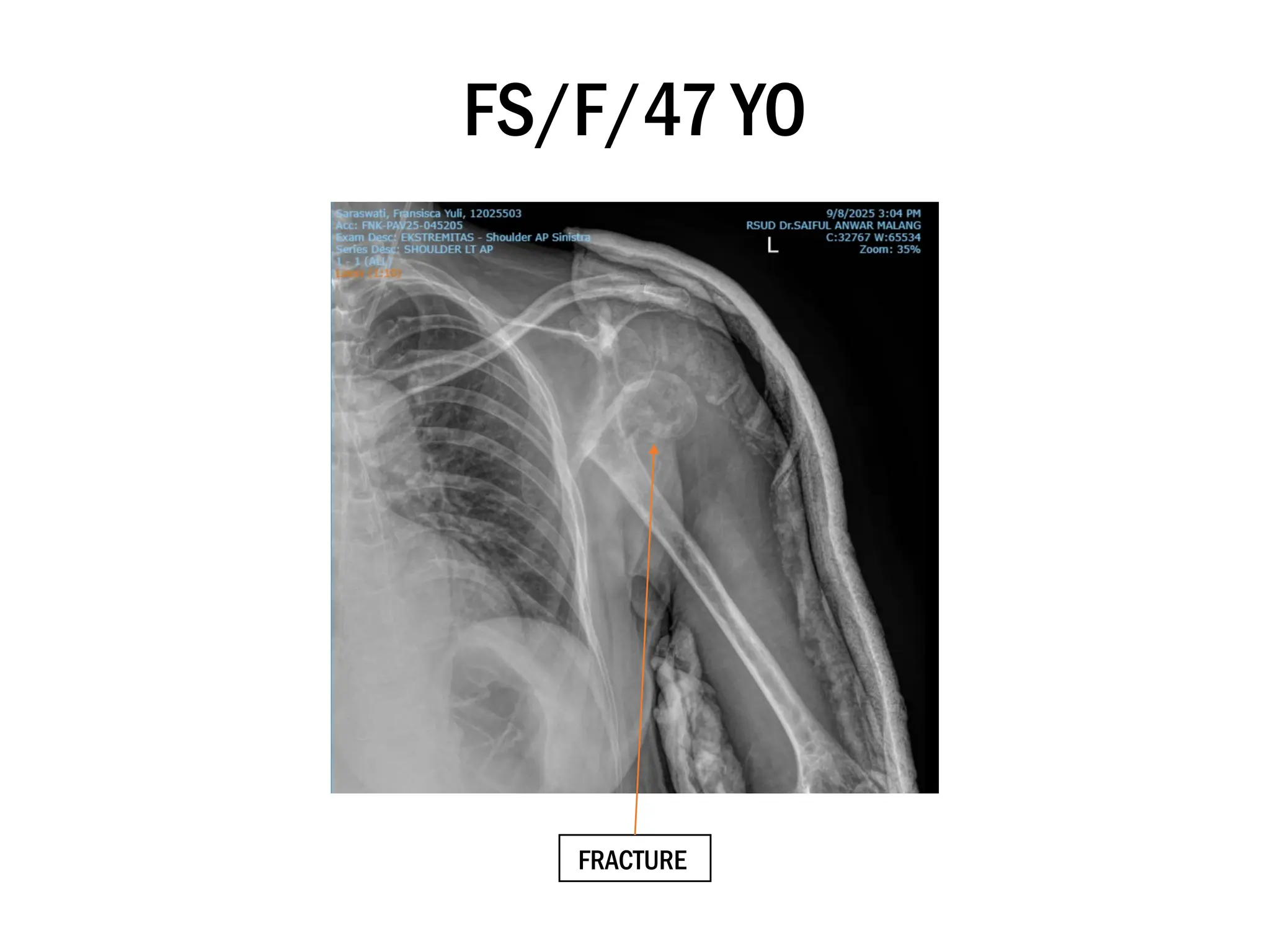 POSTWEEK HAND FRANSISCA COAPTATION SPLINT - SS.pptx