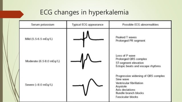 Electrocardiogram Changes With Potassium Imbalance Ecg