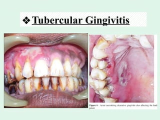Oral Manifestation of Bacterial Manifestation- TUBERCULOSIS SYPHILIS ...