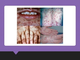 Oral Manifestation of Bacterial Manifestation- TUBERCULOSIS SYPHILIS ...
