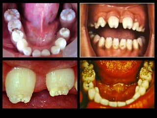 Oral Manifestation of Bacterial Manifestation- TUBERCULOSIS SYPHILIS ...
