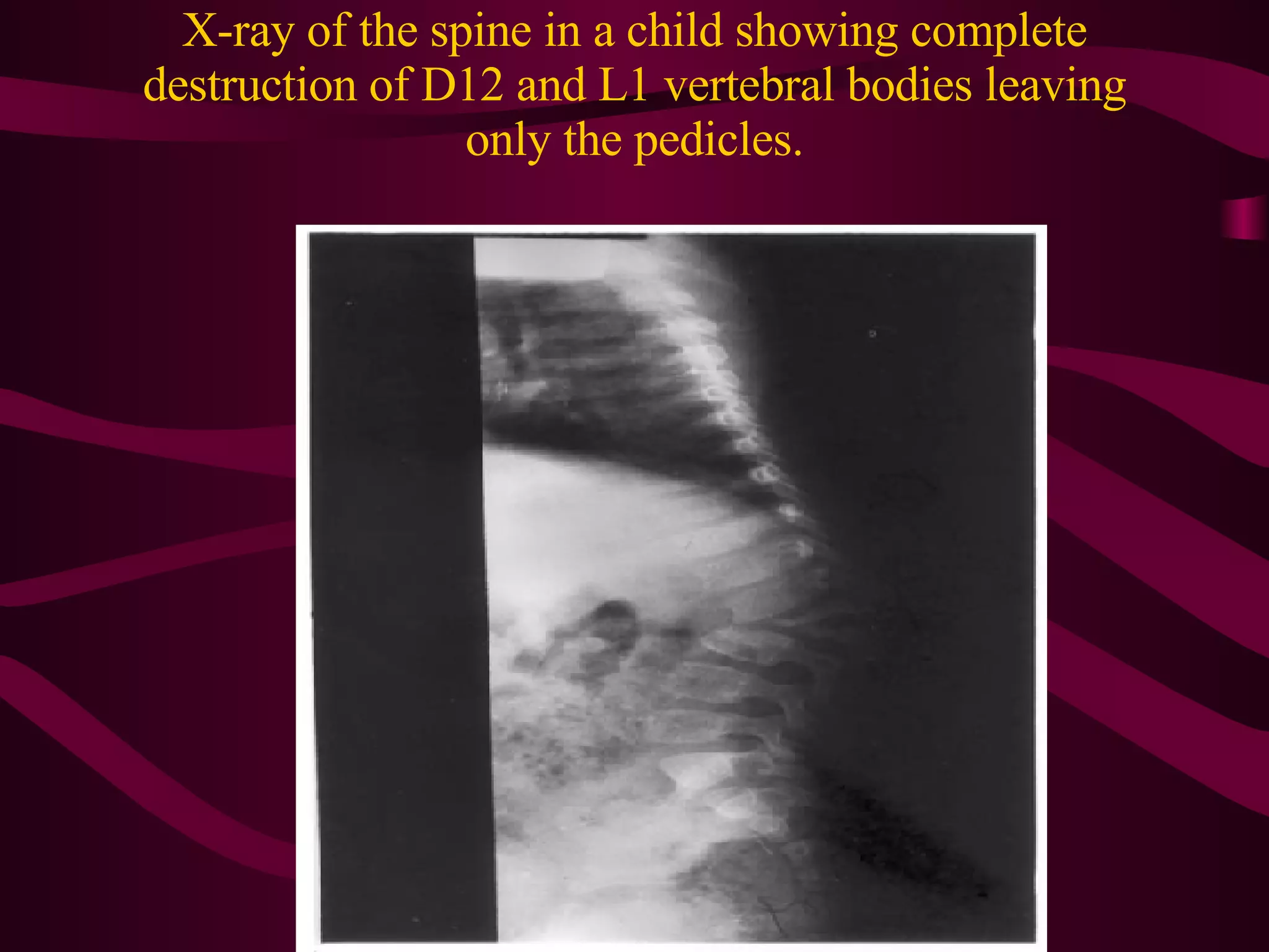 Pott Disease | PPT