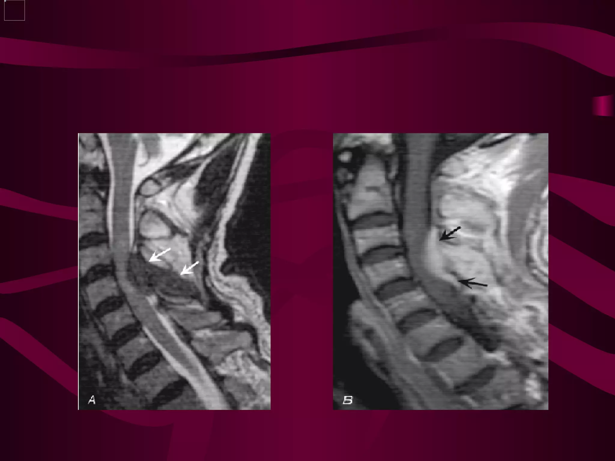 Pott Disease | PPT