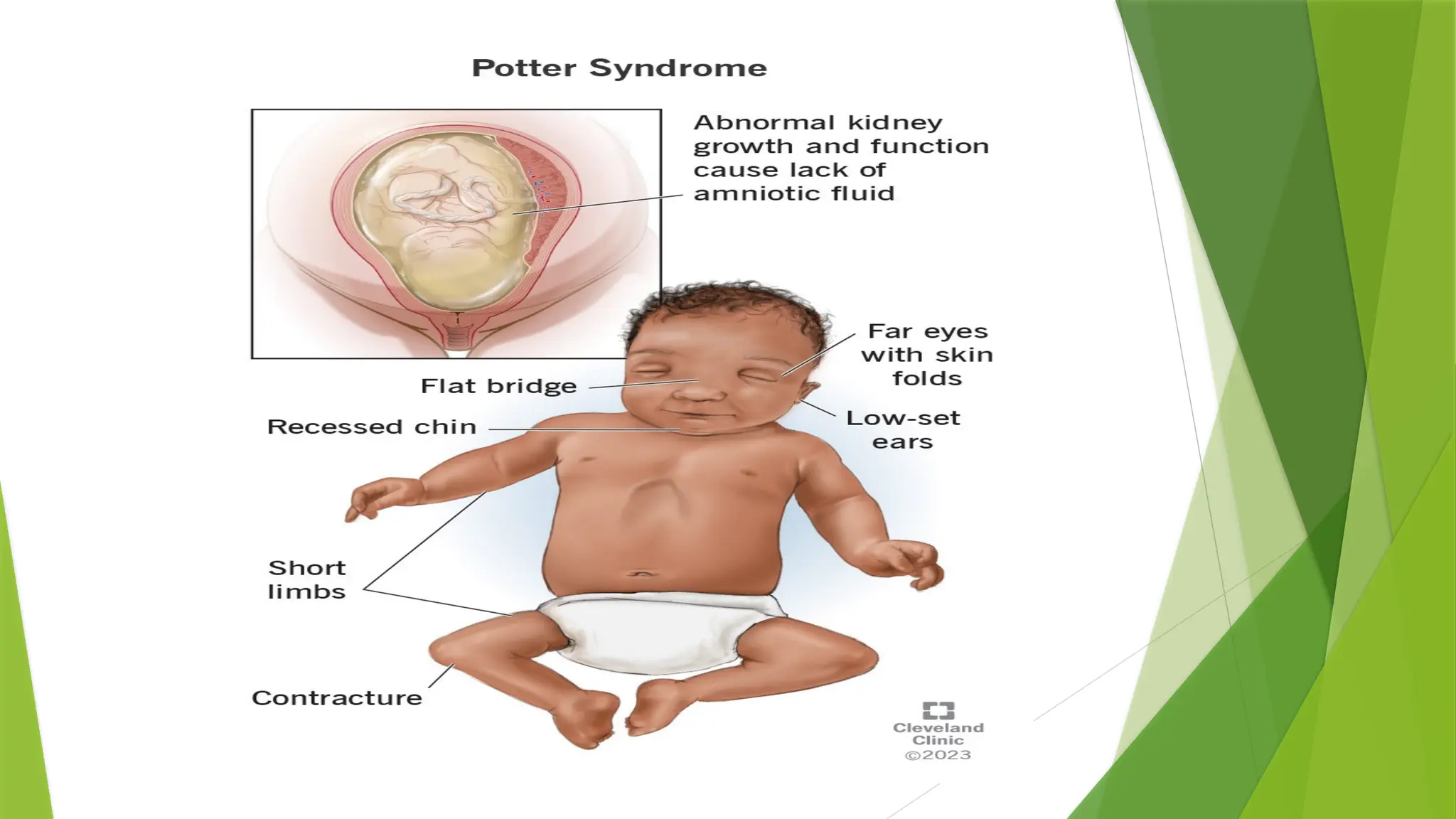 Potter syndrome and Potter phenotype refers to a group of findings ...