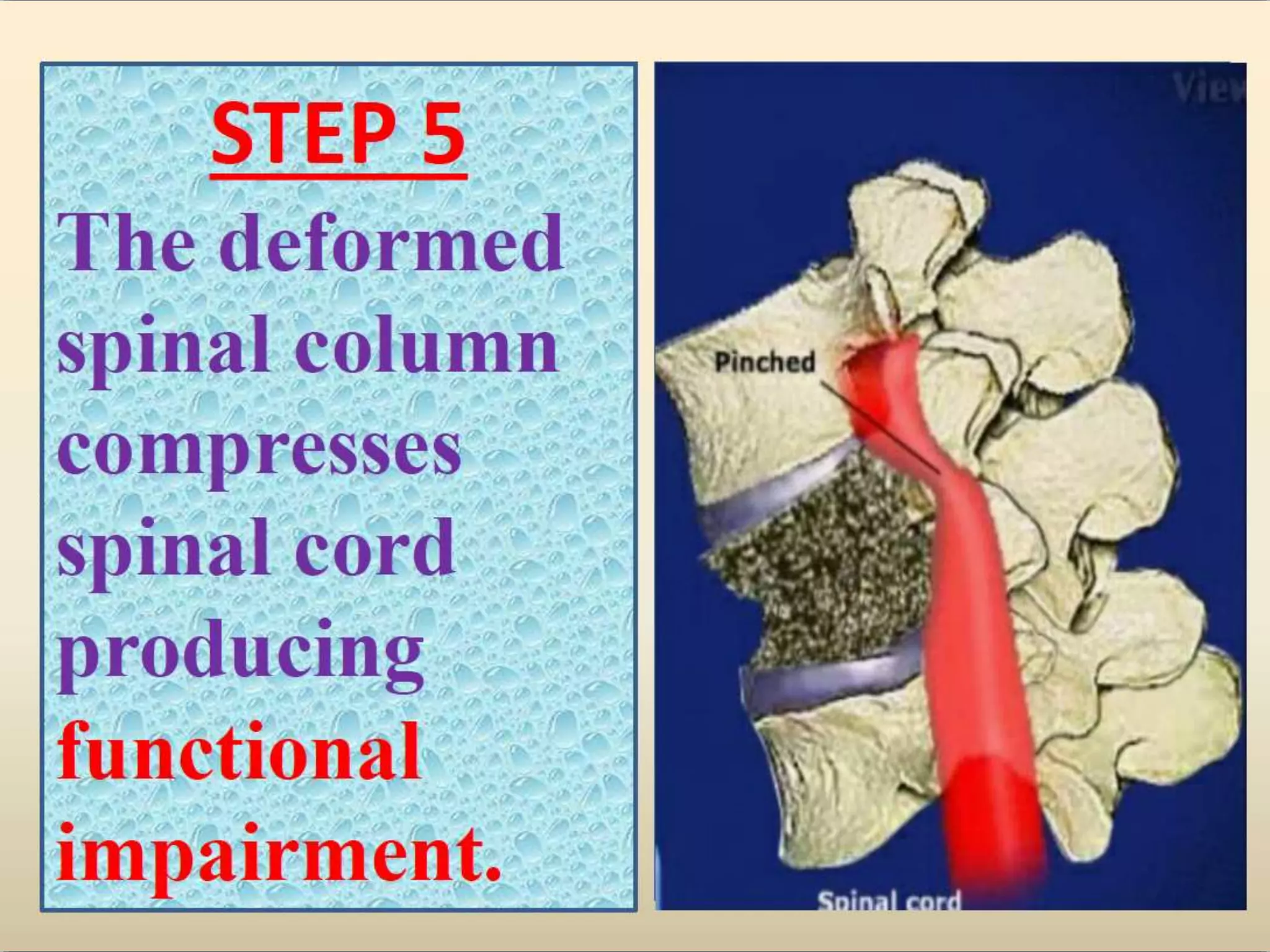 Pott's disease ppt | PPTX