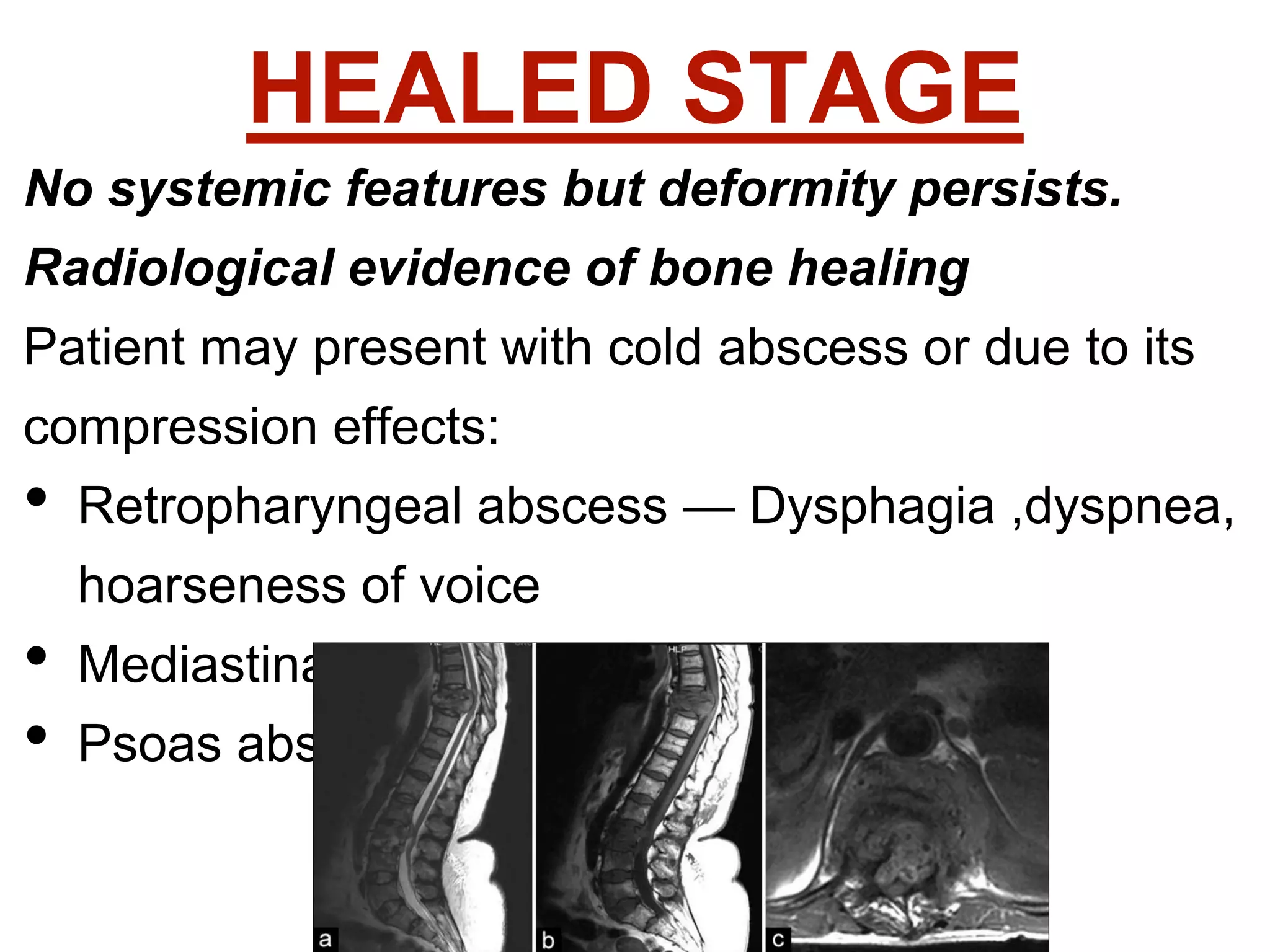 Pott's disease ppt | PPTX