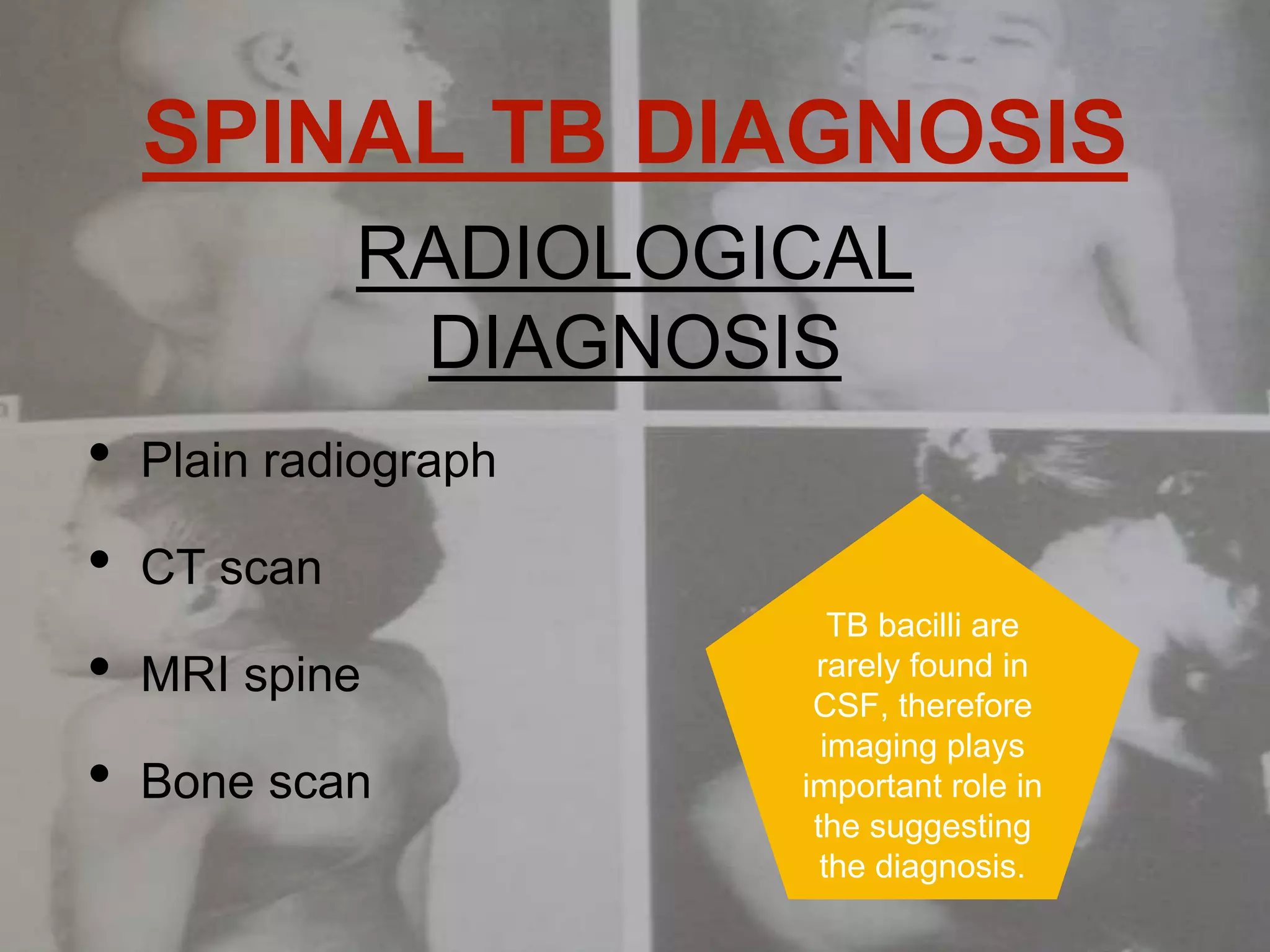Pott's disease ppt | PPTX