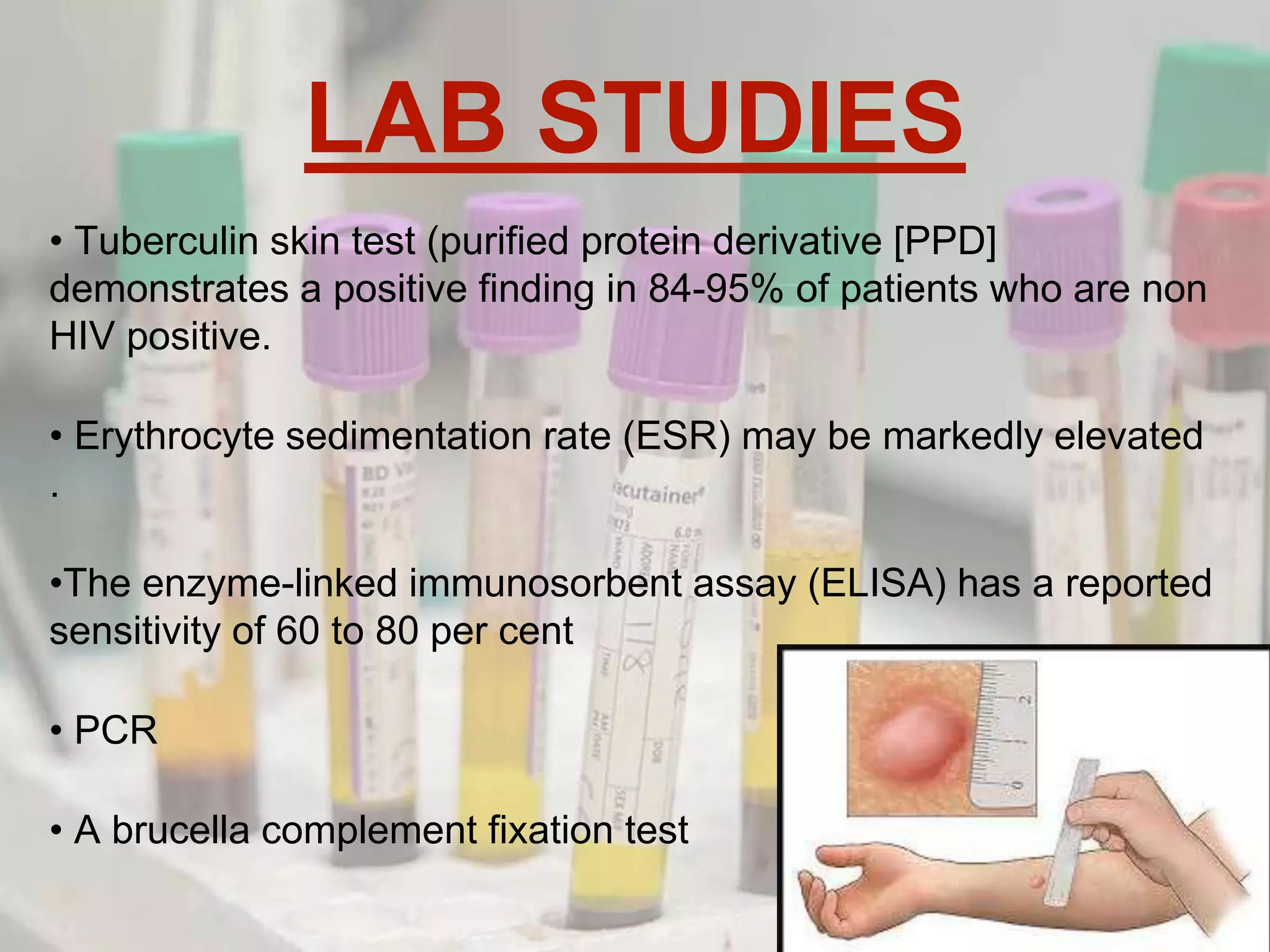 Pott's disease ppt | PPTX