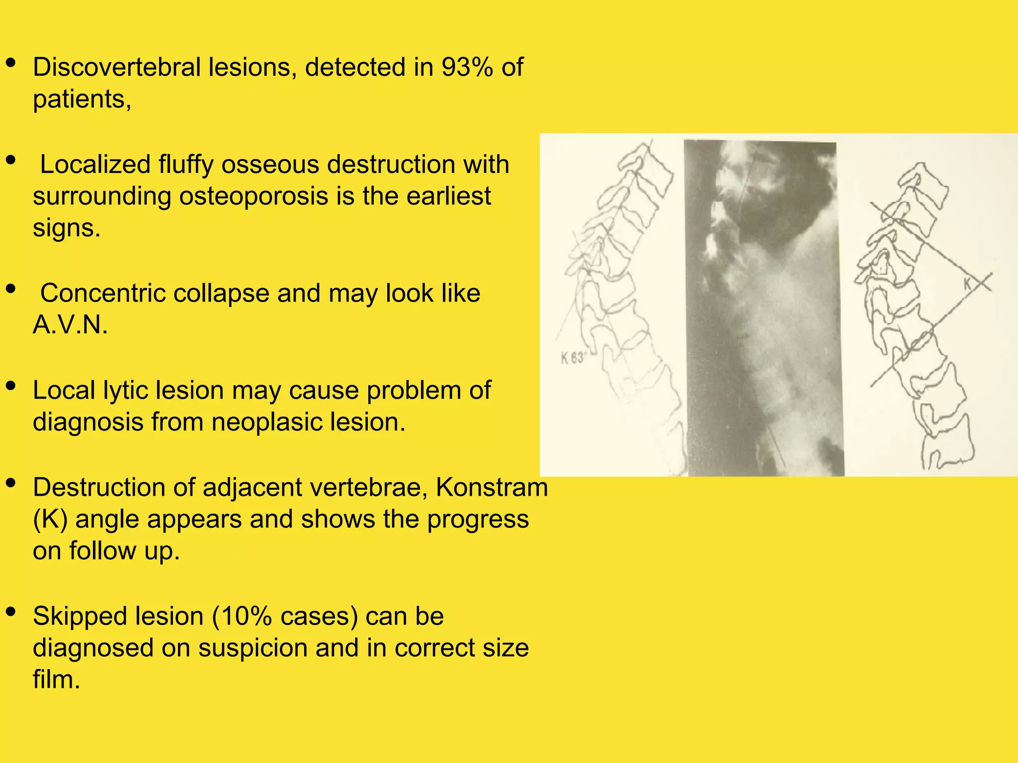 Pott's disease ppt | PPTX