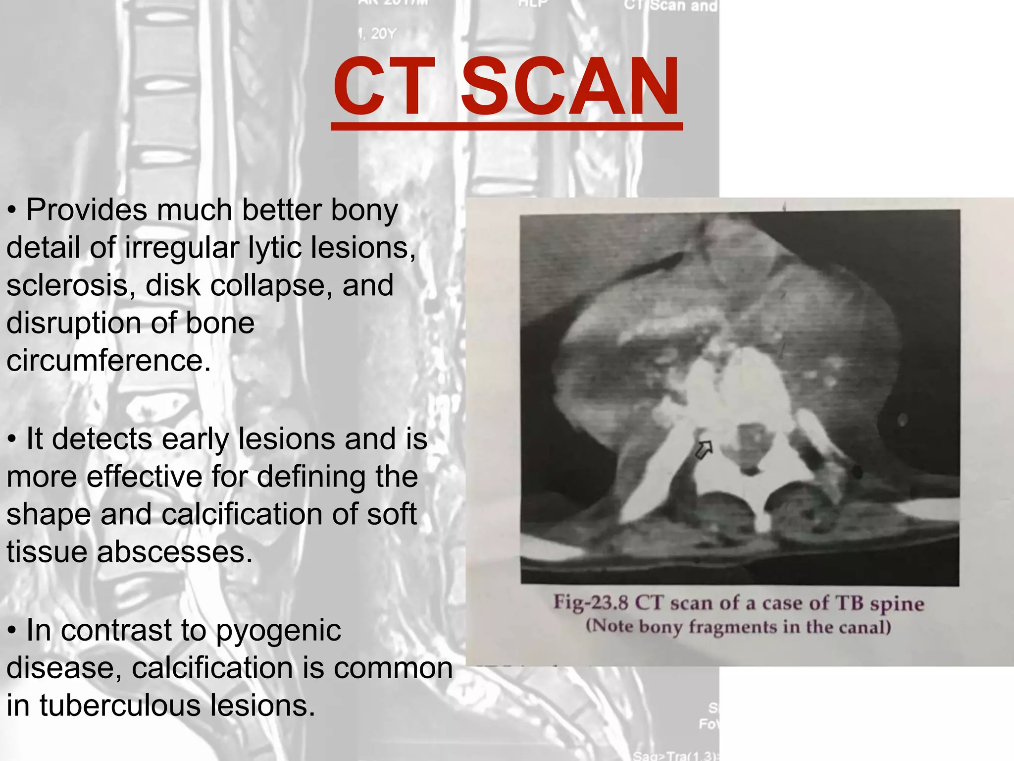 Pott's disease ppt | PPTX