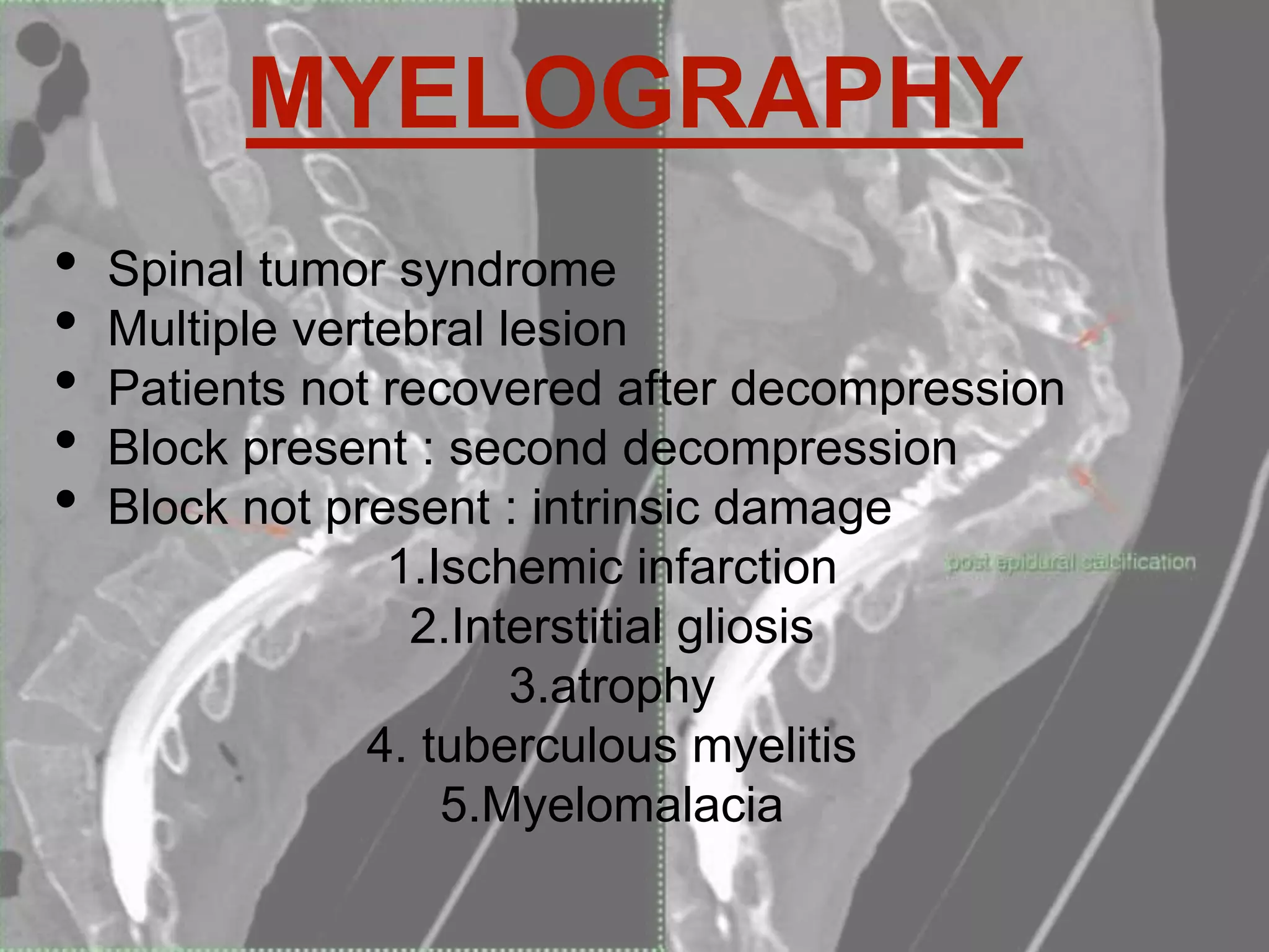Pott's disease ppt | PPTX