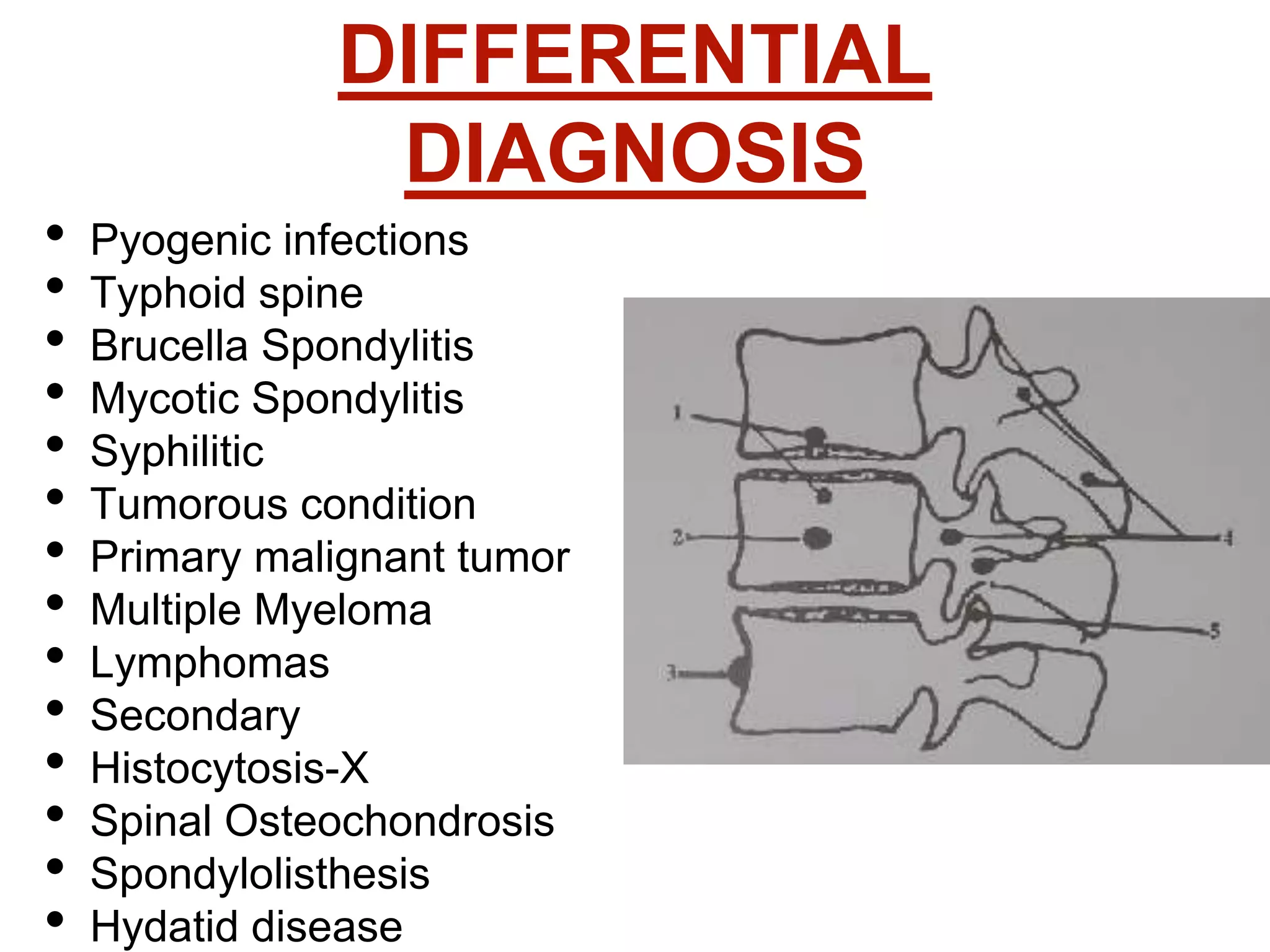 Pott's disease ppt | PPTX