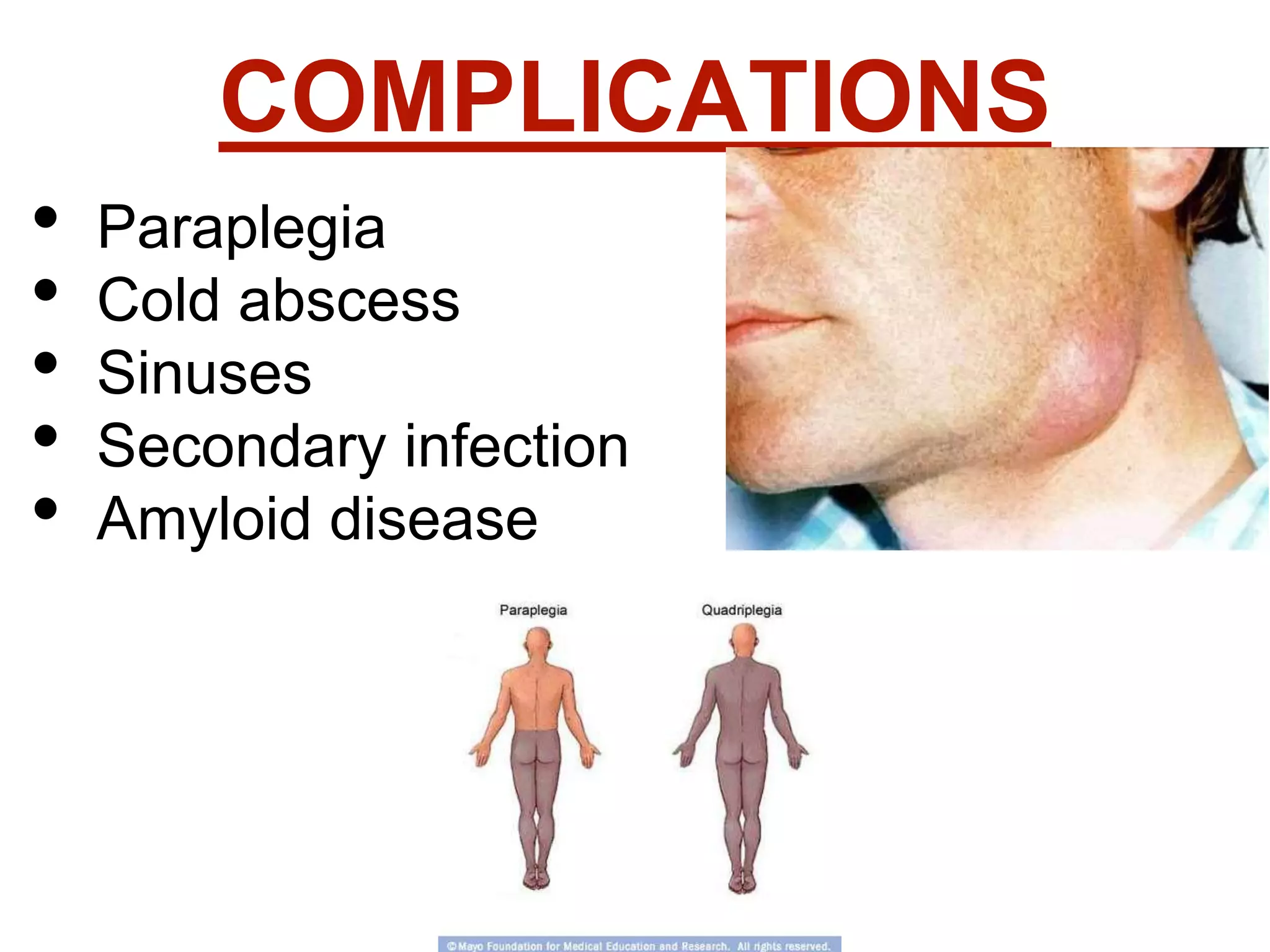 Pott's disease ppt | PPTX
