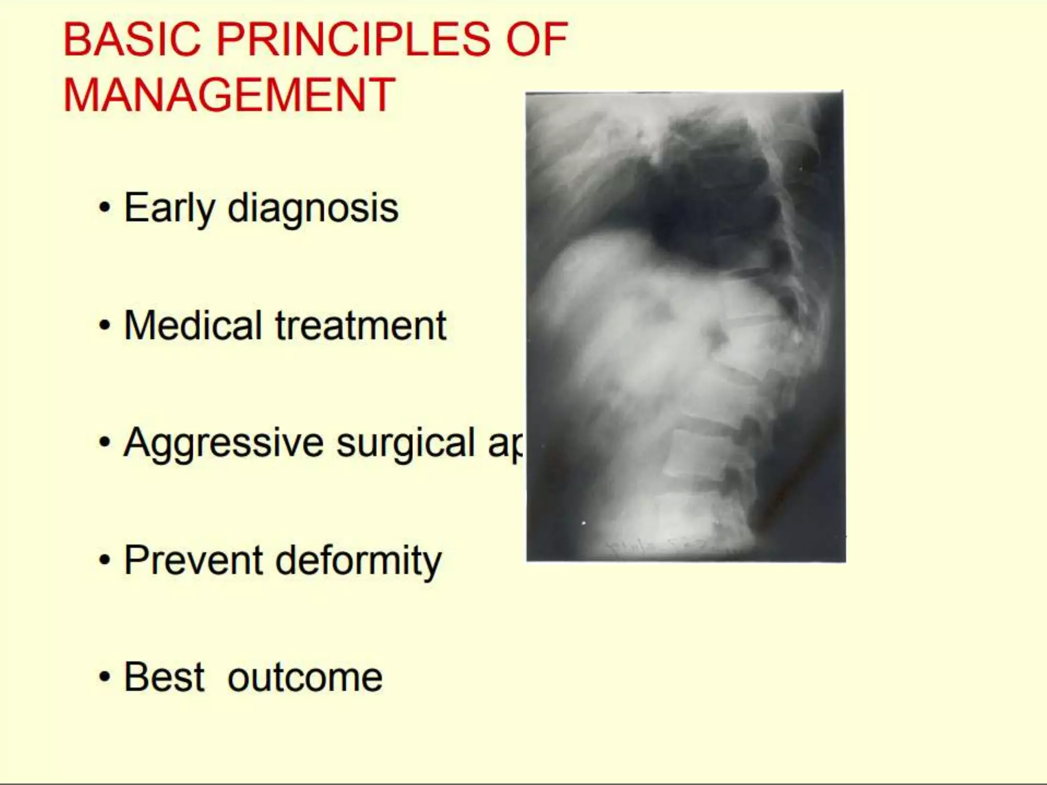 Pott's disease ppt | PPTX