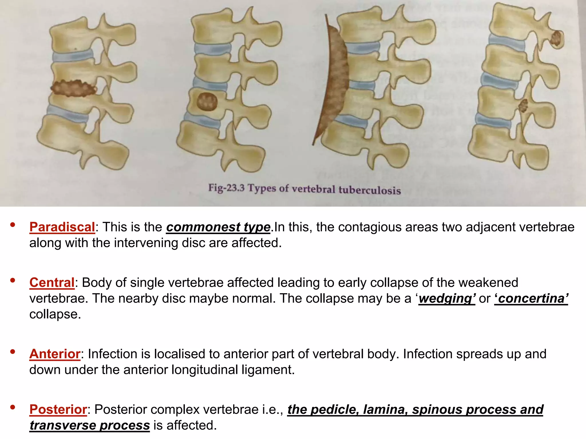Pott's disease ppt | PPTX