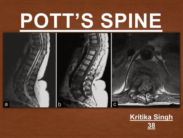 Pott's disease ppt | PPTX | Physical Therapy | Wellness