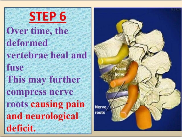 Pott's disease ppt | PPTX | Physical Therapy | Wellness