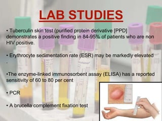 Pott's disease ppt | PPTX