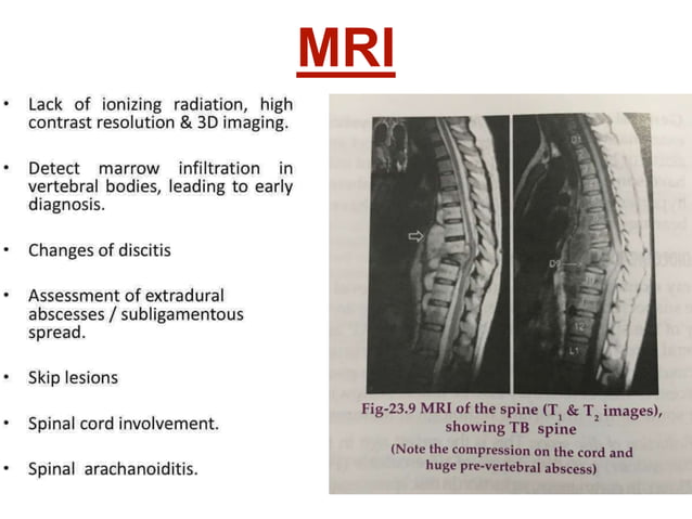 Pott's disease ppt | PPTX | Physical Therapy | Wellness