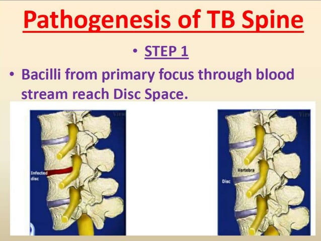 Pott's disease ppt | PPTX | Physical Therapy | Wellness