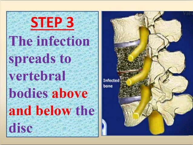 Pott's disease ppt | PPTX | Physical Therapy | Wellness