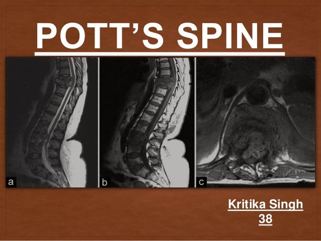 Pott's disease ppt