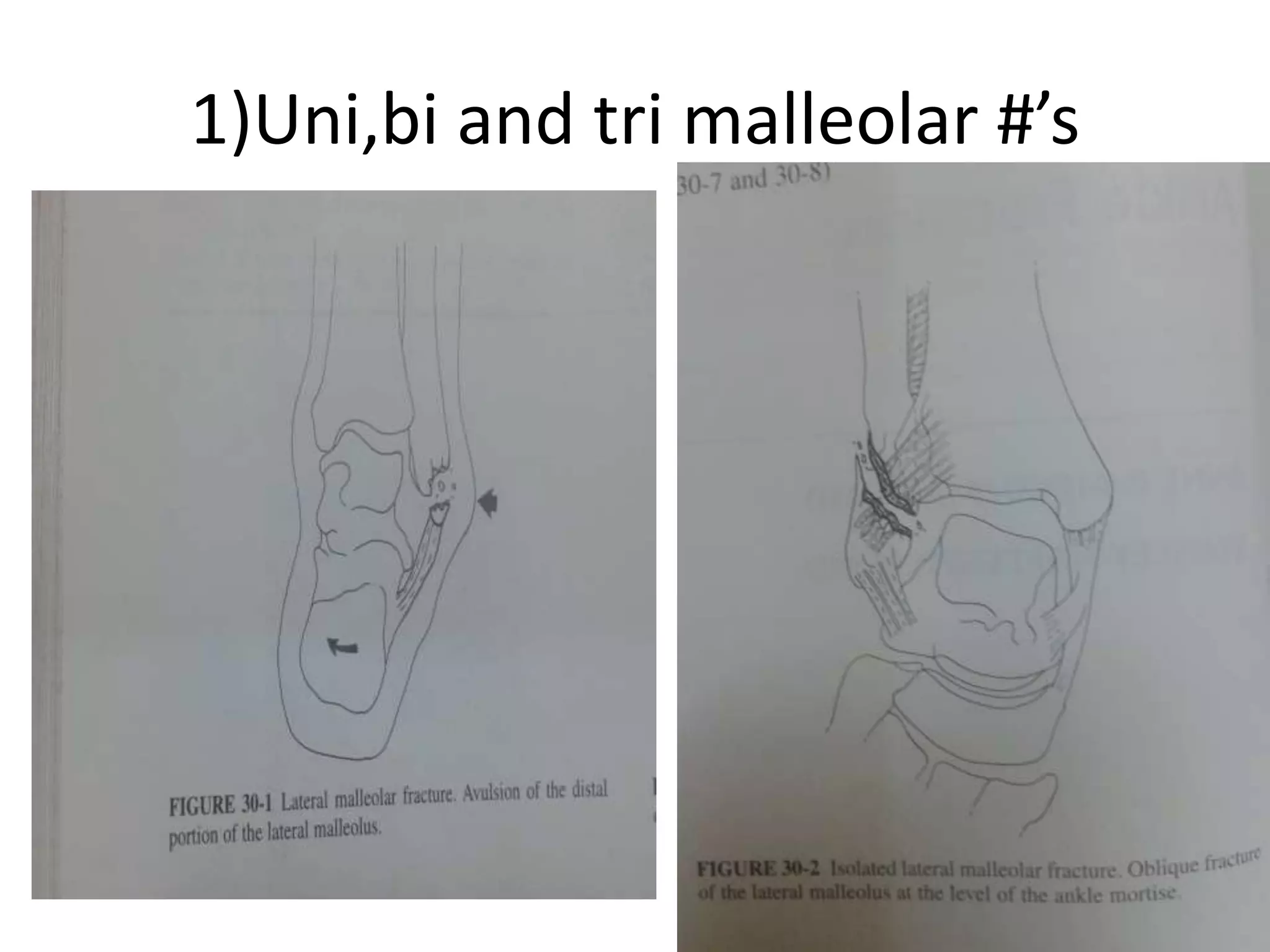 Pott’s fracture | PPTX