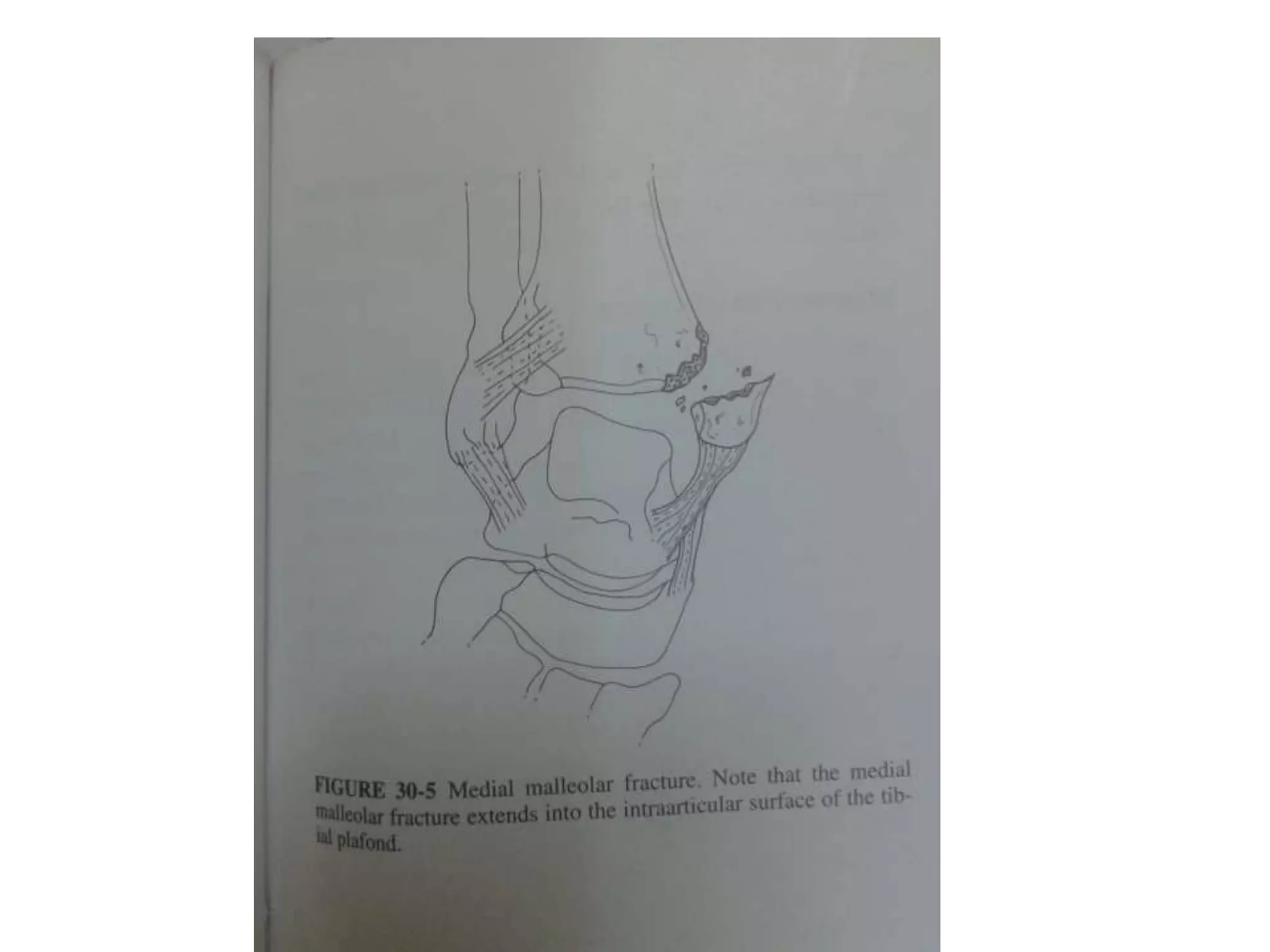 Pott’s fracture | PPTX