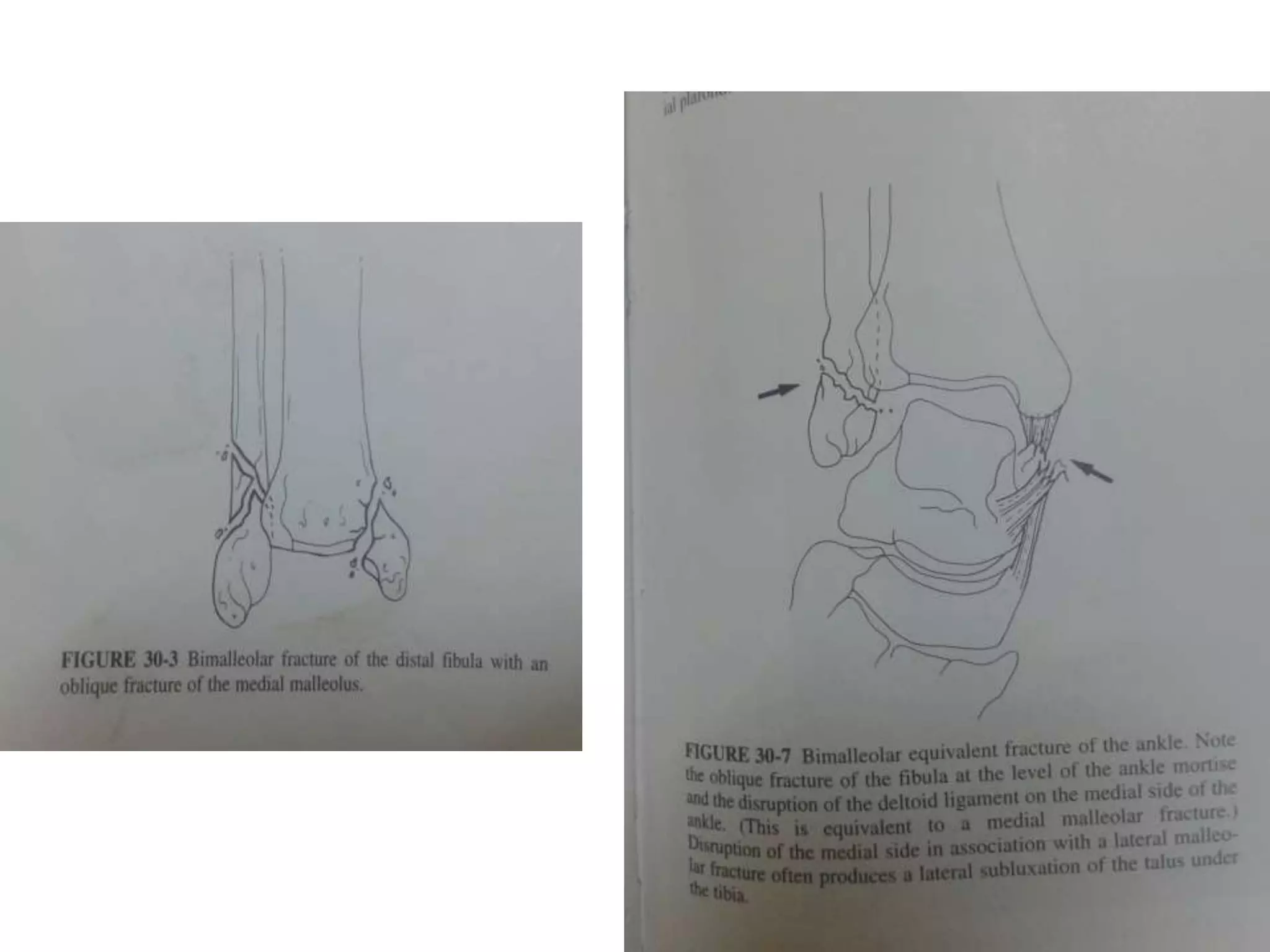 Pott’s fracture | PPTX