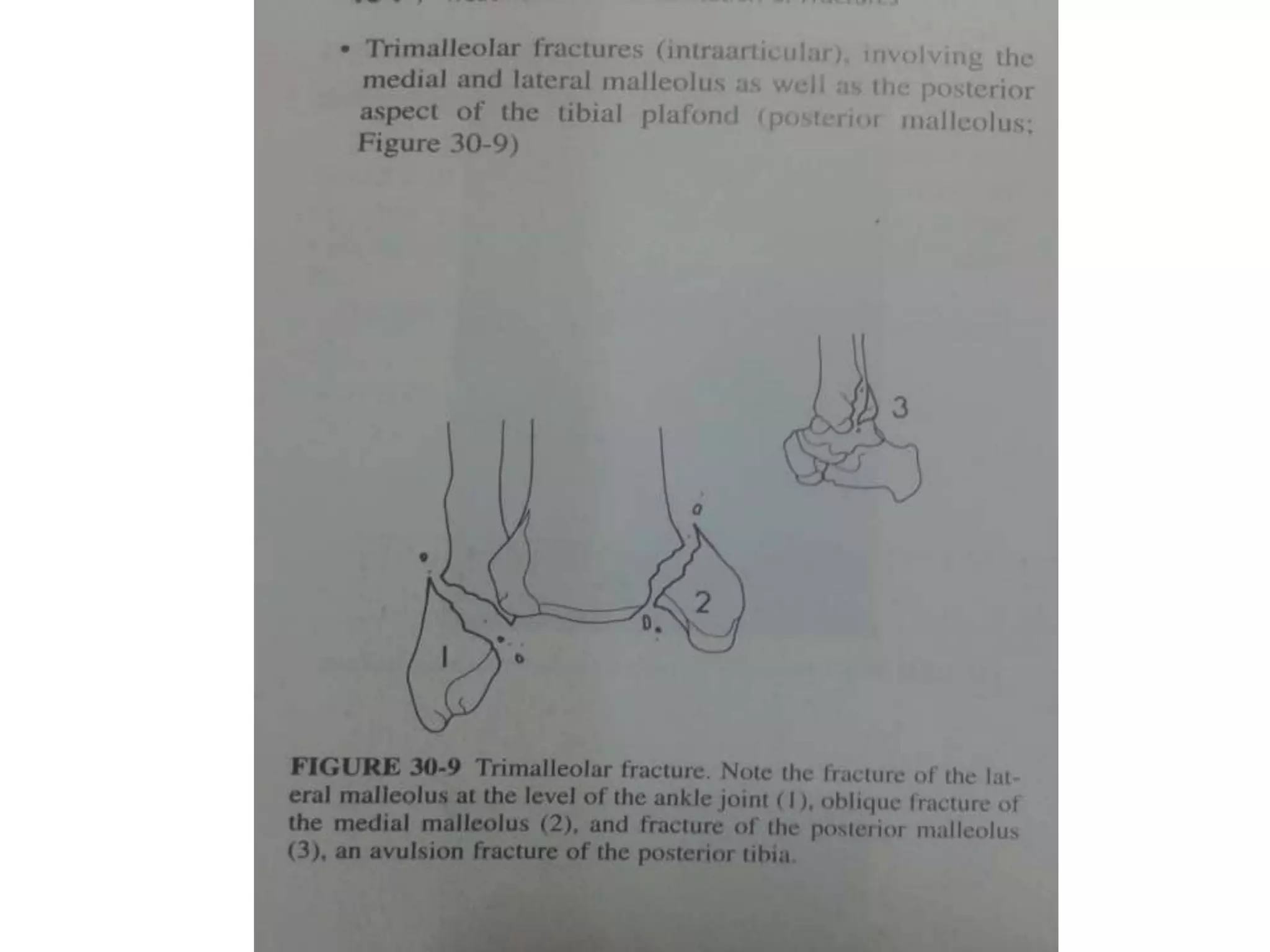 Pott’s fracture | PPTX