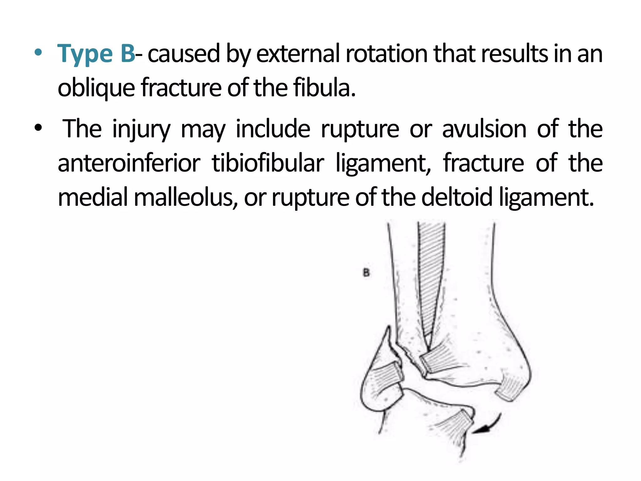 Pott’s fracture | PPTX