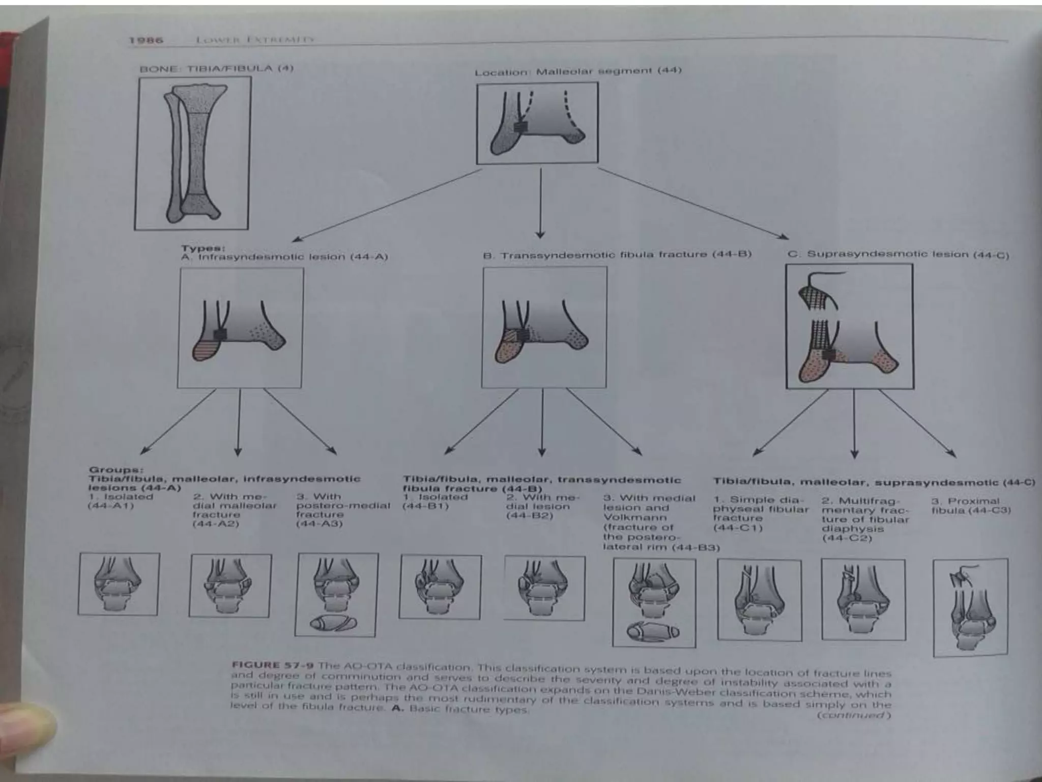 Pott’s fracture | PPTX